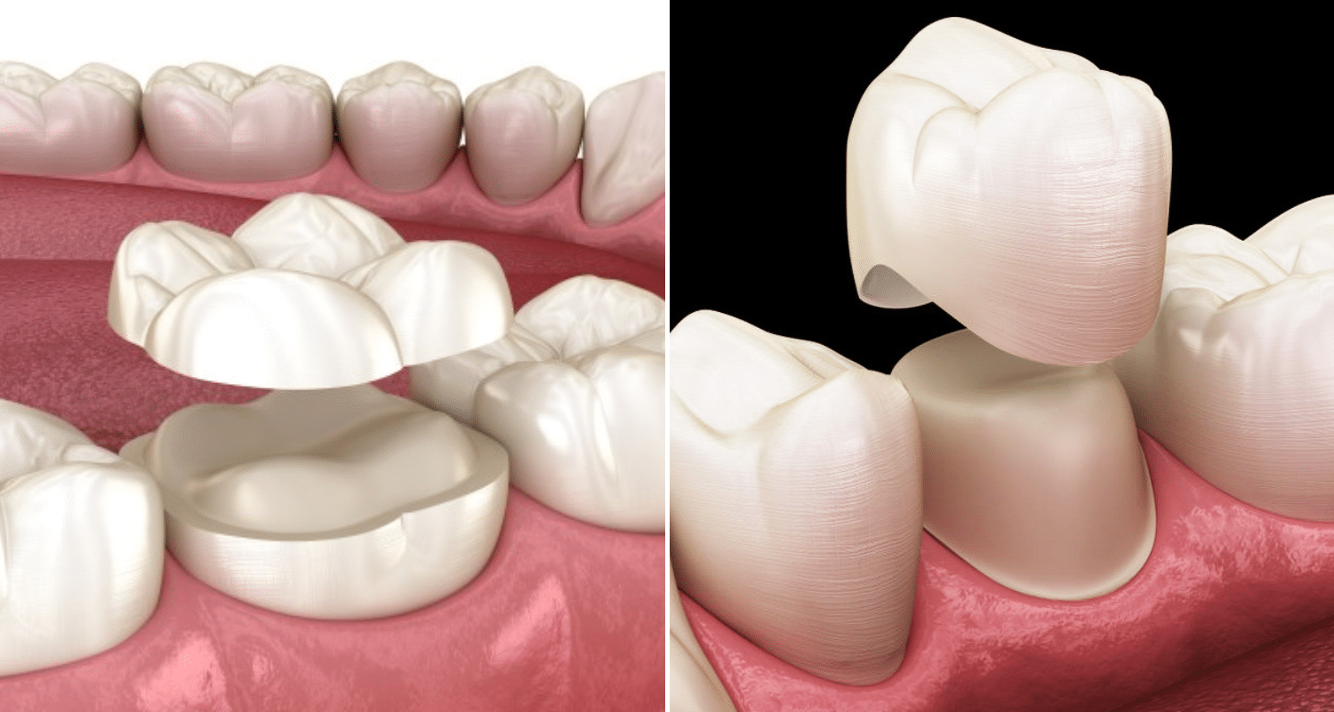 Onlays vs Crowns: Making the Best Choice for Your Dental Health in ...